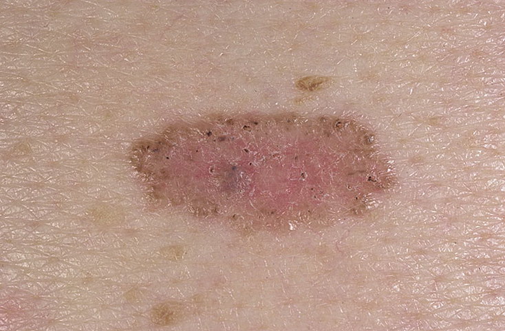 Базалиома кожи лица - что такое, лечение и прогноз